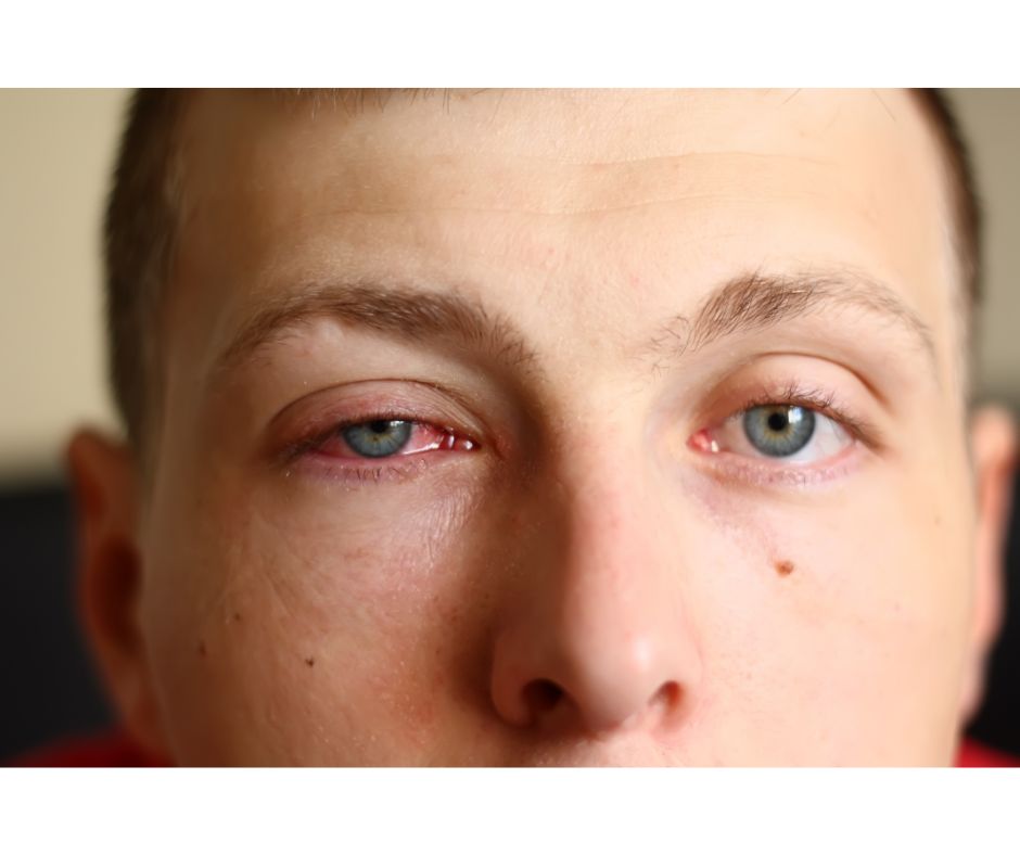 What To Do About Pink Eye by Dr. Suzy Lessing - DirectMed DPC ...